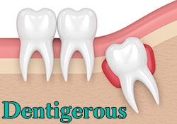 What is a Dental Cyst & How is it Treated? - Carson & Carson, DDS