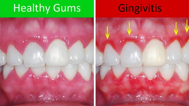 Gingivitis - Periodontal Disease - CarsonDDS.com Gingivitis - Periodontal Disease - CarsonDDS.com